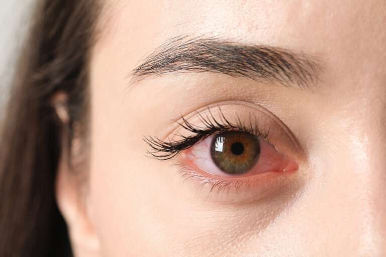 How Does COVID-19 Affect Your Eyes? - Keck Medicine of USC