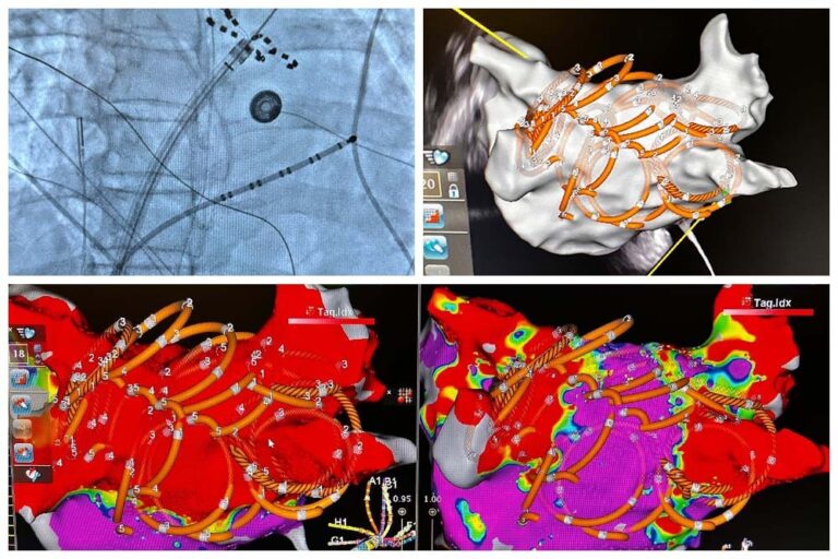 Is Pulsed Field Ablation as Promising as It Sounds? | Keck Medicine of USC